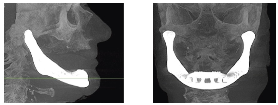 Woman Needs New Jaw, Gets First 3D Printed Transplant | Science and ...